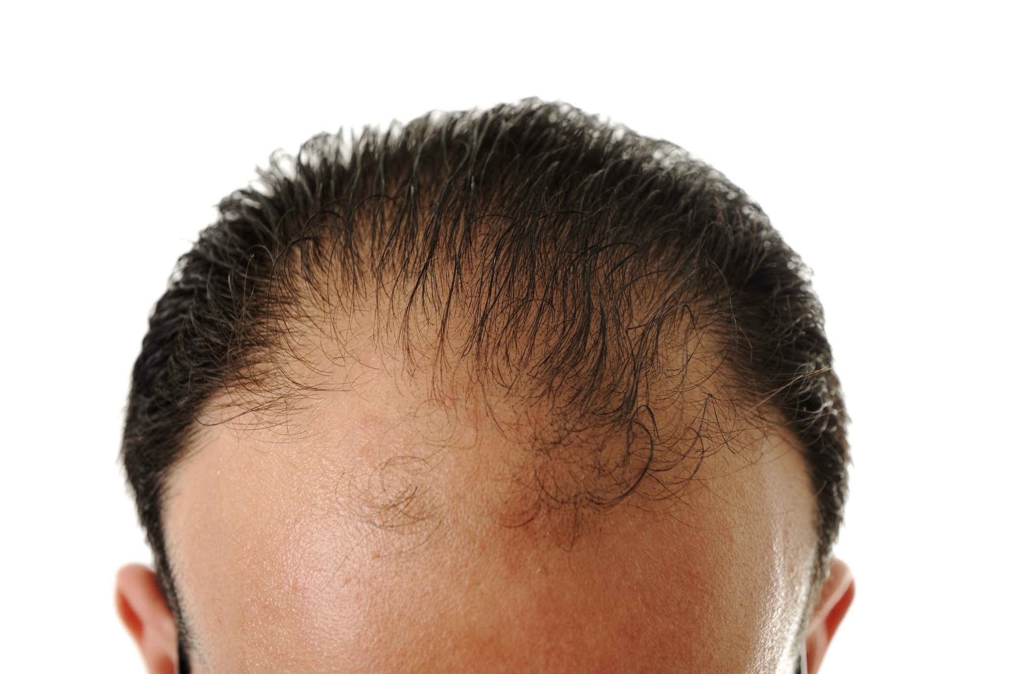 New Treatment Shows Promise to Reverse Male-Pattern Baldness